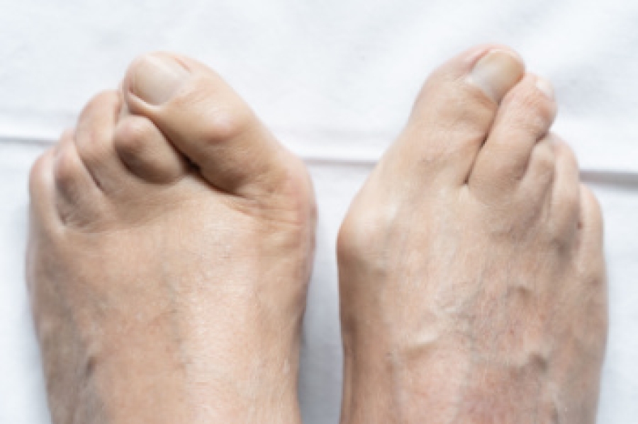 Symptoms and Causes of Bunions